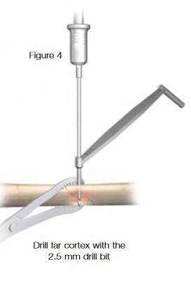 Zimmer Biomet Drill Bits - BIT, DRILL, 2.5MM, SMALL FRAG PLATESVA ONLY ...