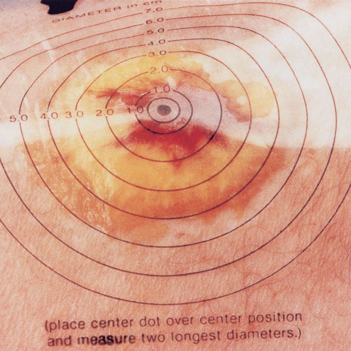 Patterson Medical Disposable Measuring Device — Grayline Medical