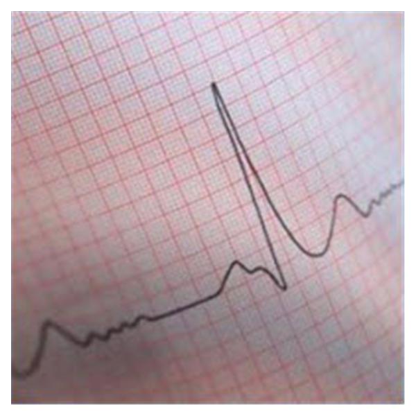 Precision Charts Recording Paper ECG/EKG Kendall For Quinton Ea, 10 EA ...