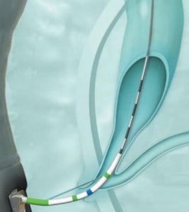 Olympus America CleverCut Sphincterotomes - CleverCut Sphincterotome ...