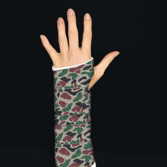 Patterson Medical Delta Cast Prints — Grayline Medical